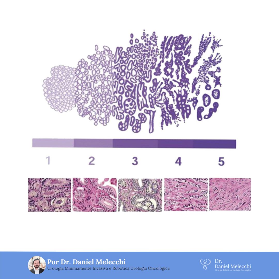 Gleason. Qual seu significado no resultado da biópsia de próstata?